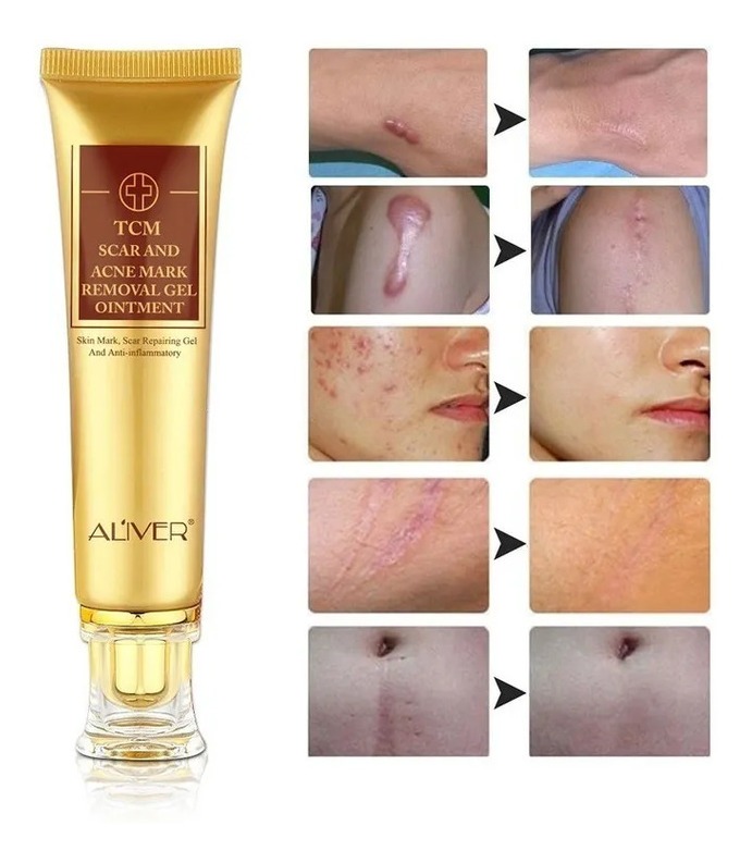 Pomada Para Remover Diminui Cicatrizes Do Rosto Frete Grátis