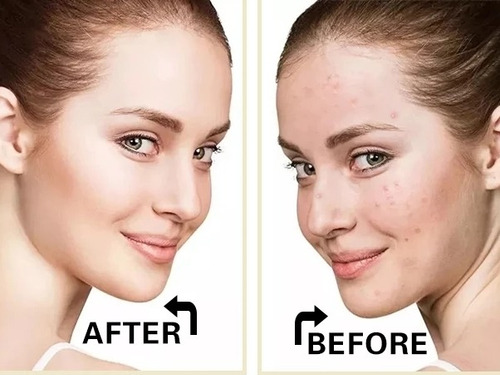Set Mascarilla Facial Aloe Vera Antiacne Hidratante Cuotas Sin Interés