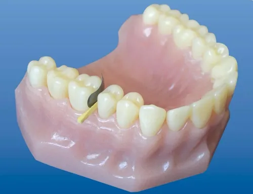 Pack 100 Matrizes Dental Seccionadas + 2 Grampos | Parcelamento sem juros Pack 100 Matrizes Dental Seccionadas + 2 Grampos | Parcelamento sem juros