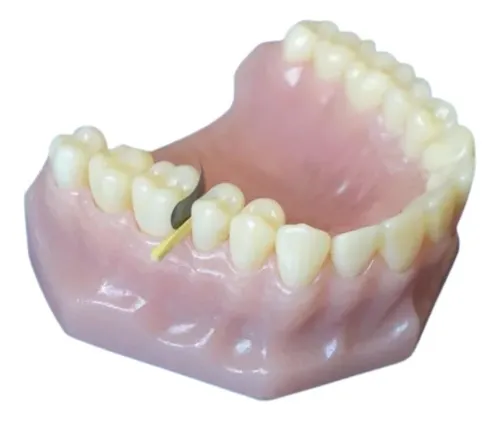 Kit 100 Matrizes Dentarias Seccionadas + 2 Grampos Sm | Parcelamento ... Kit 100 Matrizes Dentarias Seccionadas + 2 Grampos Sm | Parcelamento ...