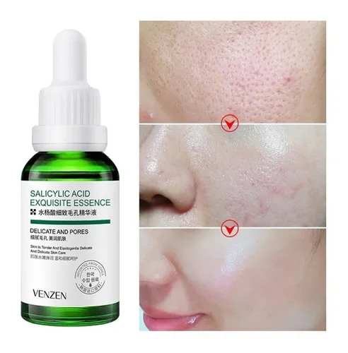 Sérum Suero Antiacné Con Ácido Salicílico Venzen Acne Solution Para Todos Os Tipos De Pele
